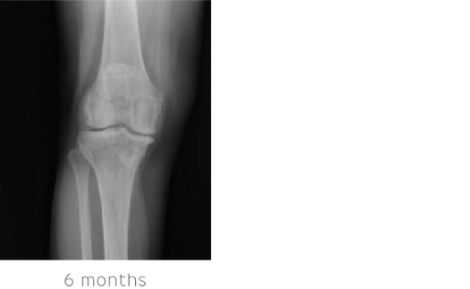 Infected Knee Joint Surgery | Osteomyelitis Treatment | Biocomposites