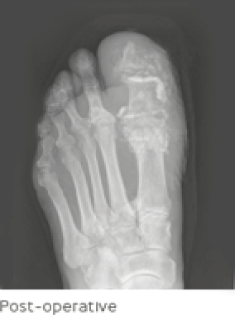 Transform Osteomyelitis In Diabetic Foot | Biocomposites